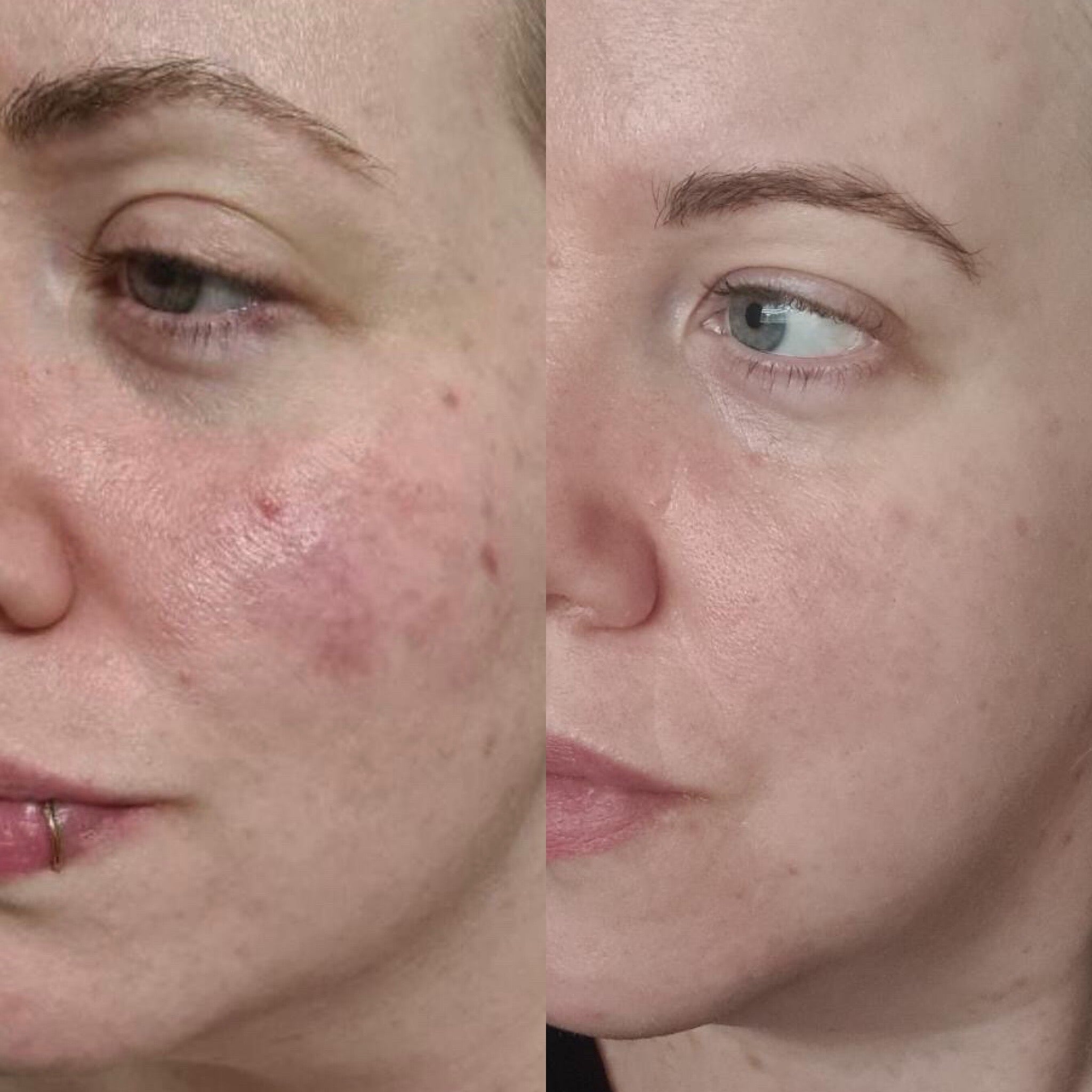 Transformations – Skin Love Clinic
