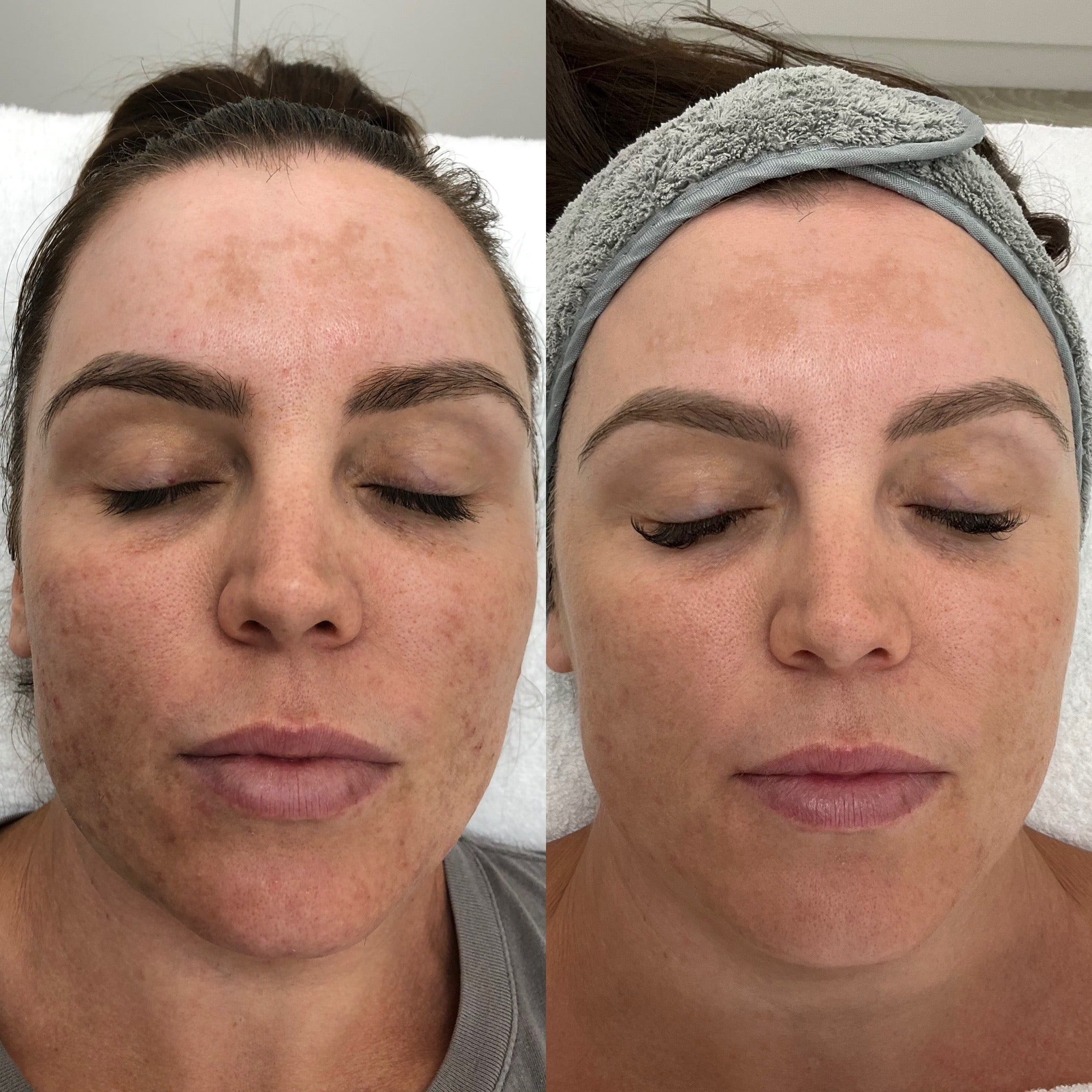 Transformations – Skin Love Clinic