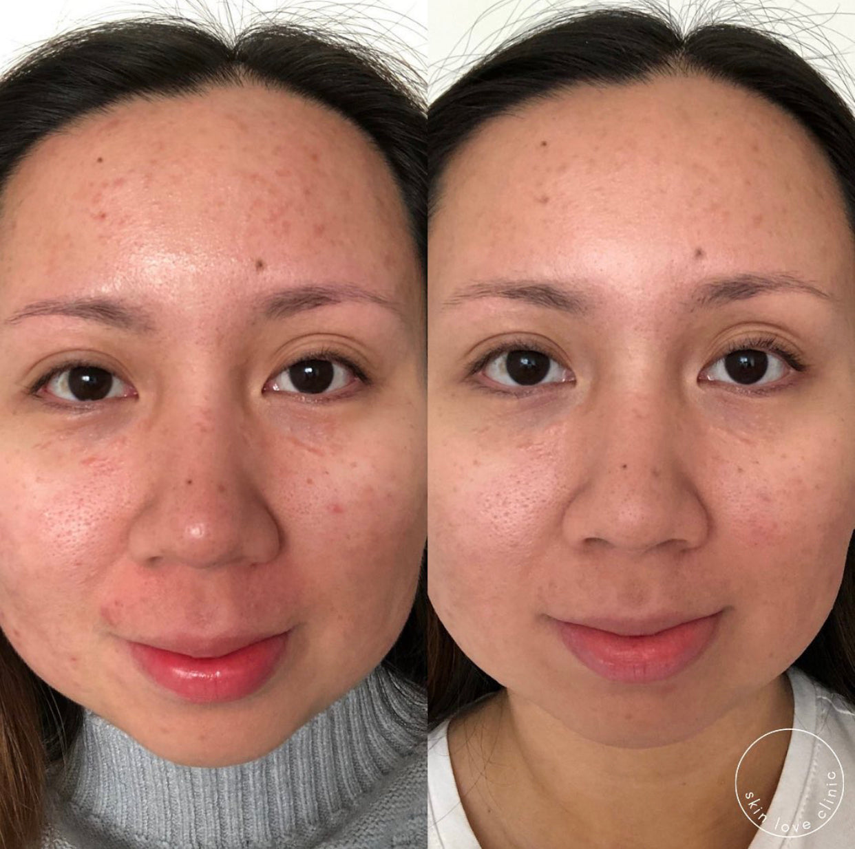 Transformations – Skin Love Clinic
